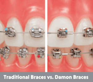 Damon Braces | Self-Ligating Brace | Park Orthodontics Glasgow