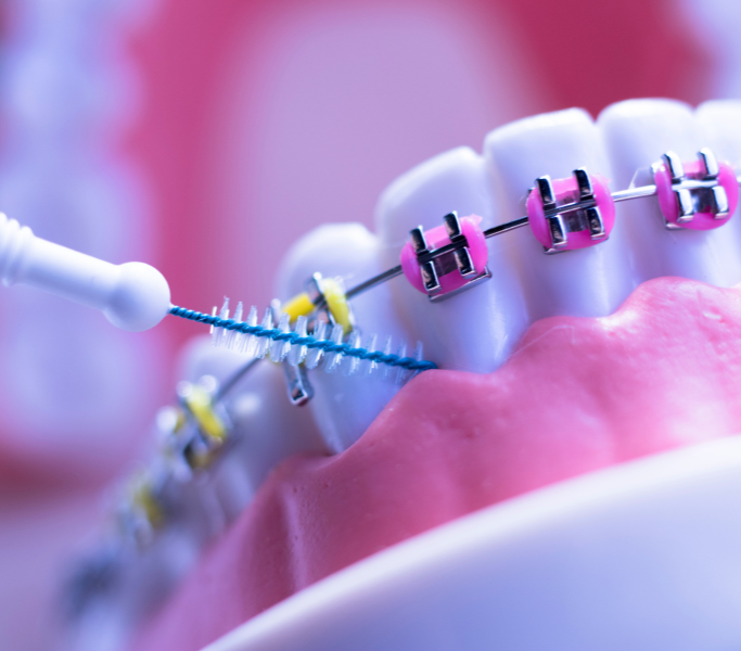 Teens Orthodontics | Park Orthodontics Glasgow