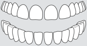 How to Know if You Need Braces - A Guide for Children and Adults