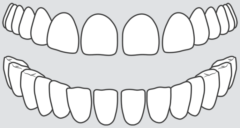 How to Know if You Need Braces - A Guide for Children and Adults