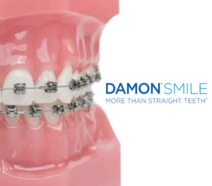Damon Braces | Self-Ligating Brace | Park Orthodontics Glasgow